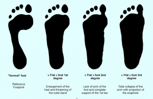 Flat Feet - All You Need to Know | Running Shoes Guru