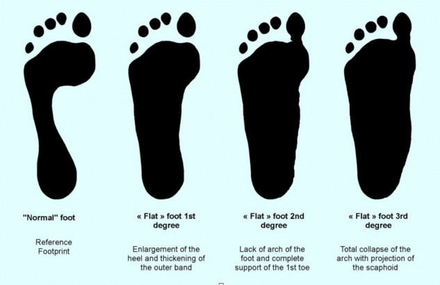 Flat Feet - All You Need to Know | Running Shoes Guru