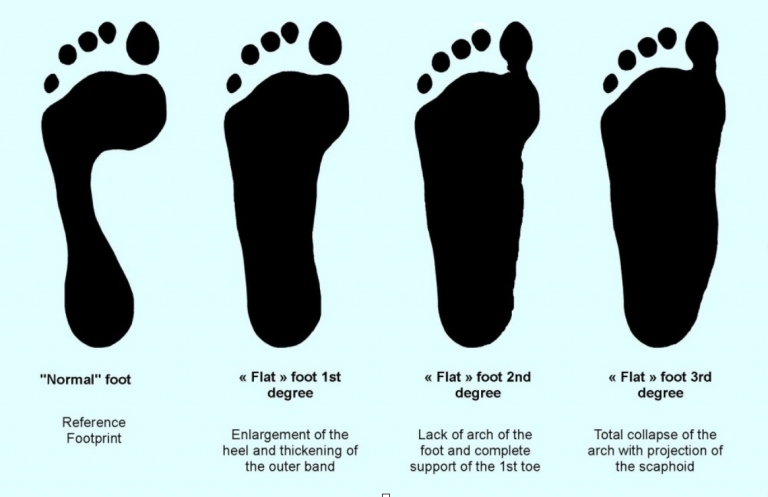 Flat Feet - All You Need to Know | Running Shoes Guru
